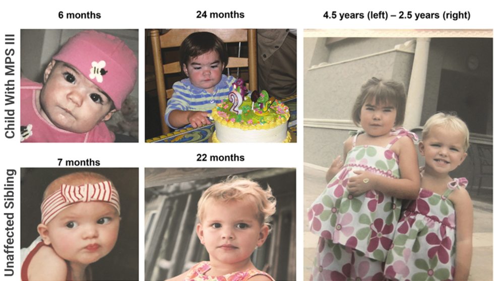 Signs & Symptoms of Sanfilippo Syndrome