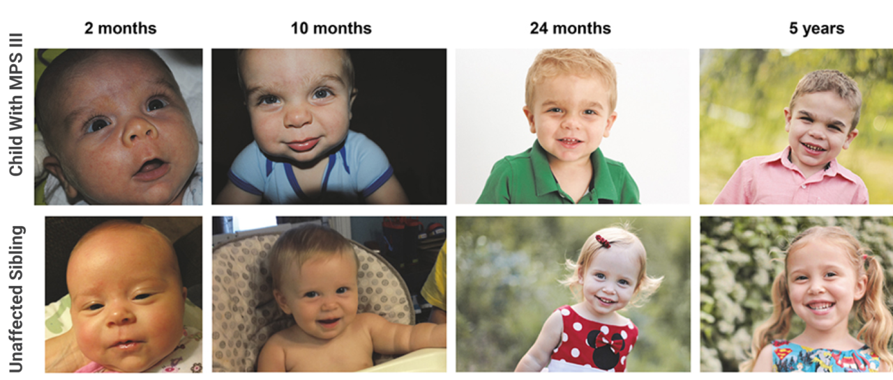 The Early and Later Symptoms of Sanfilippo Syndrome